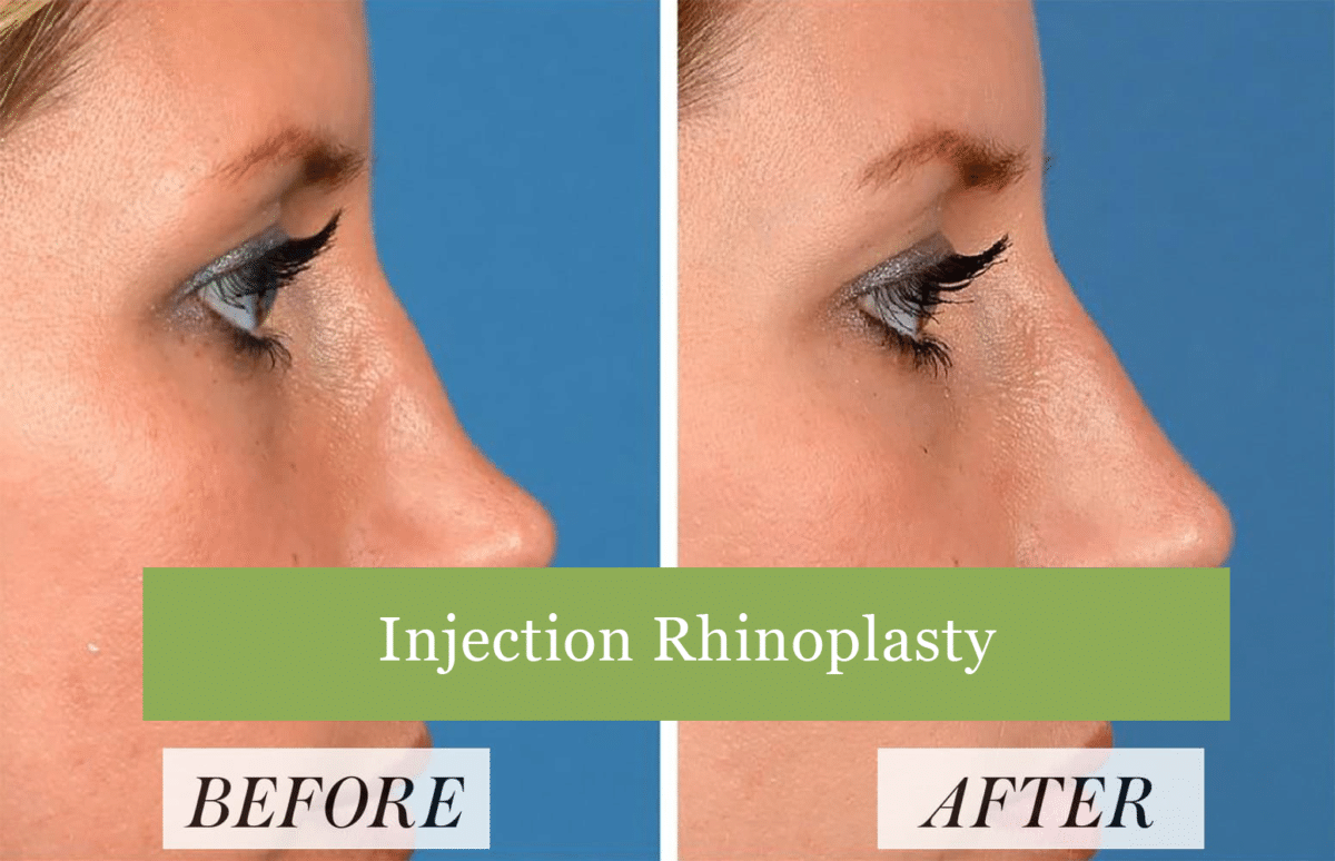 Injection Rhinoplasty - Rainforest Medical Aesthetics